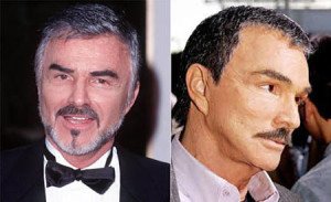 Burt Reynolds Plastic Surgery and Cosmetic Alterations